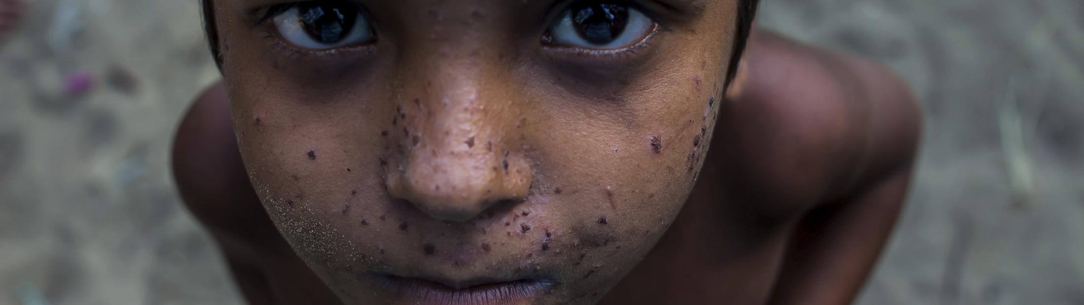 Cinco años de éxodo rohingya | eACNUR